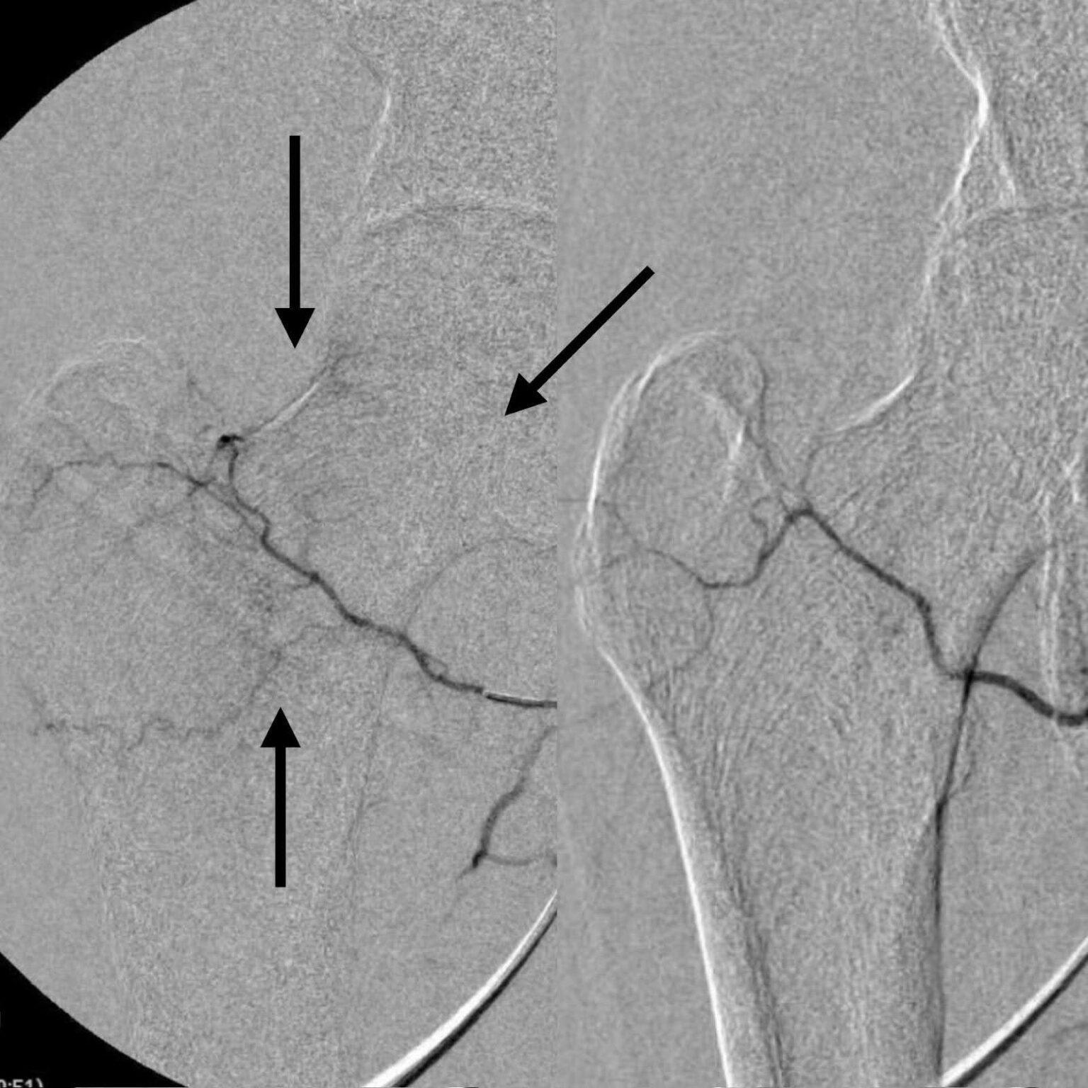 Hip Arthritis & Bursitis Embolization in Falls Church, VA